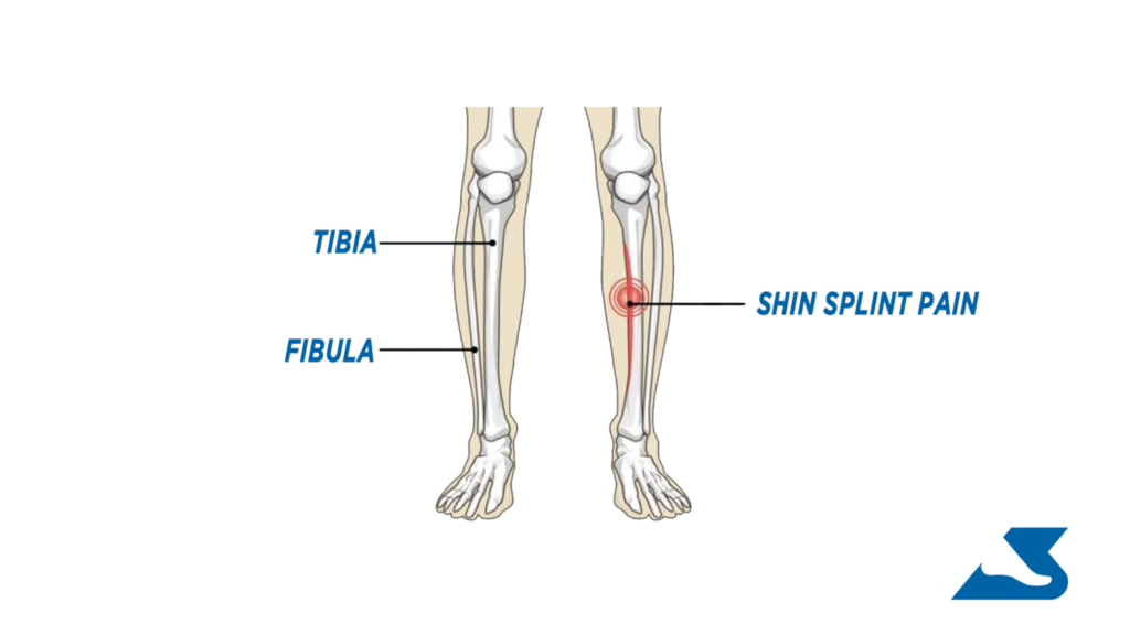 What Are Shin Splints And How To Treat Them - BioPed Footcare