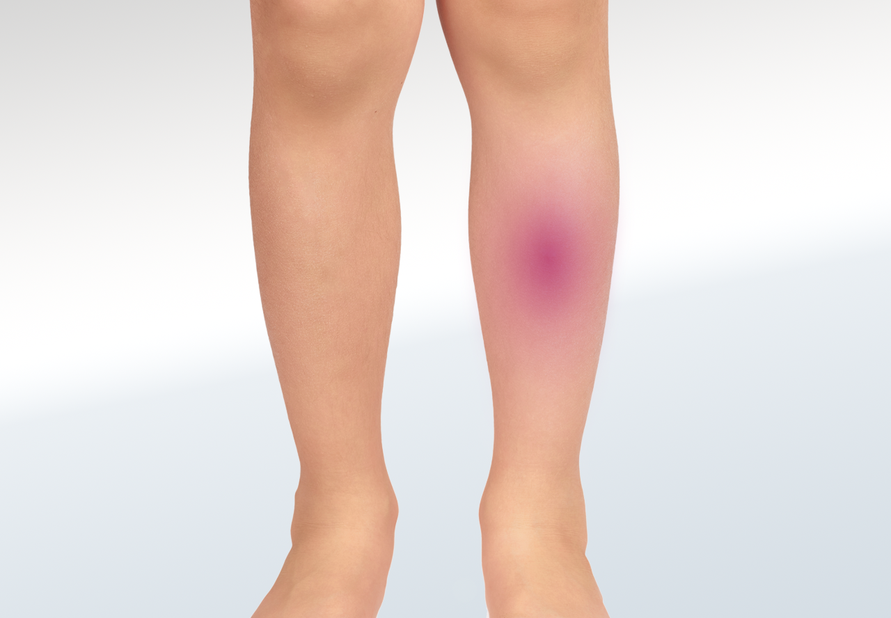 Stress Fracture - Relieve Foot Pain & Leg Pain