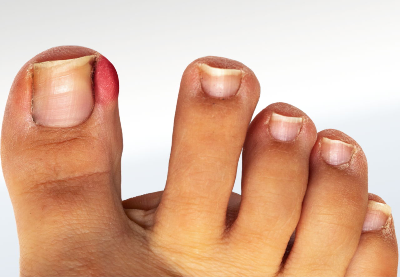 Ingrown - Relieve Foot Pain & Leg Pain