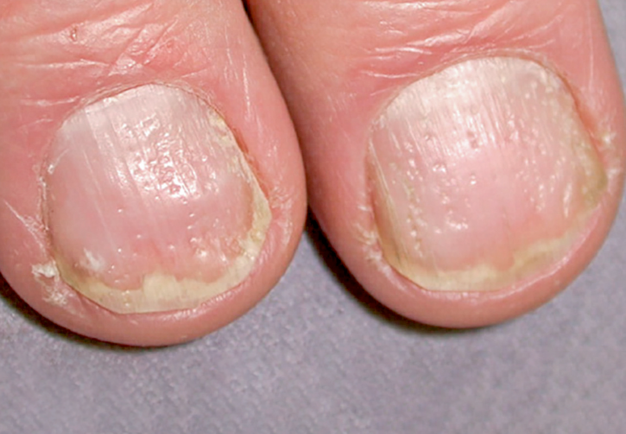 Pitting - Relieve Foot Pain & Leg Pain