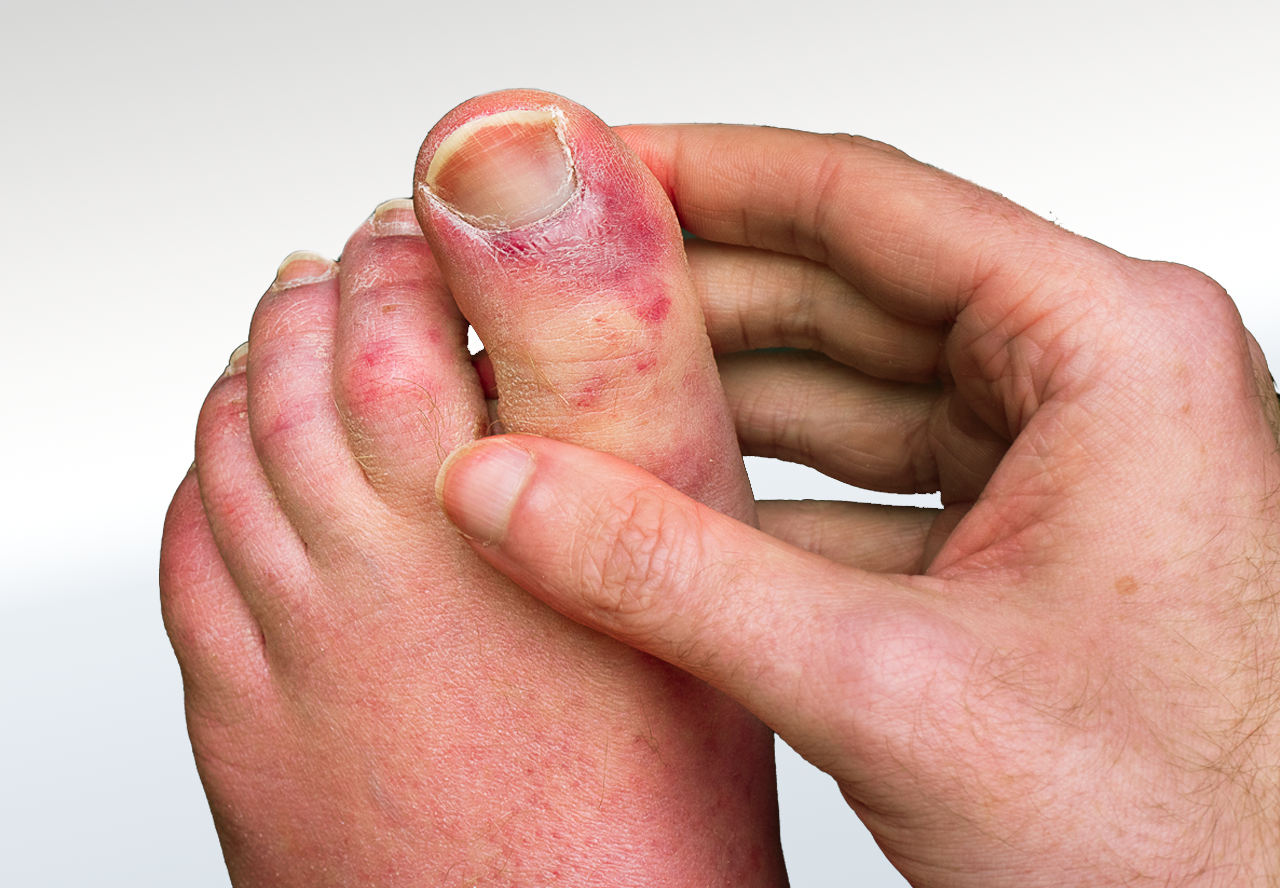Bacterial/Fungal Skin Infection - Relieve Foot Pain & Leg Pain