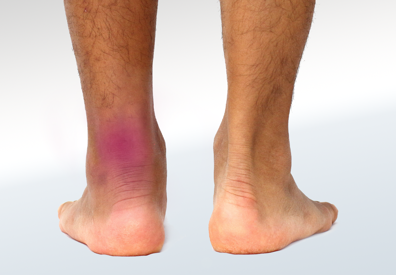 Achilles Rupture/Tear - Relieve Foot Pain & Leg Pain