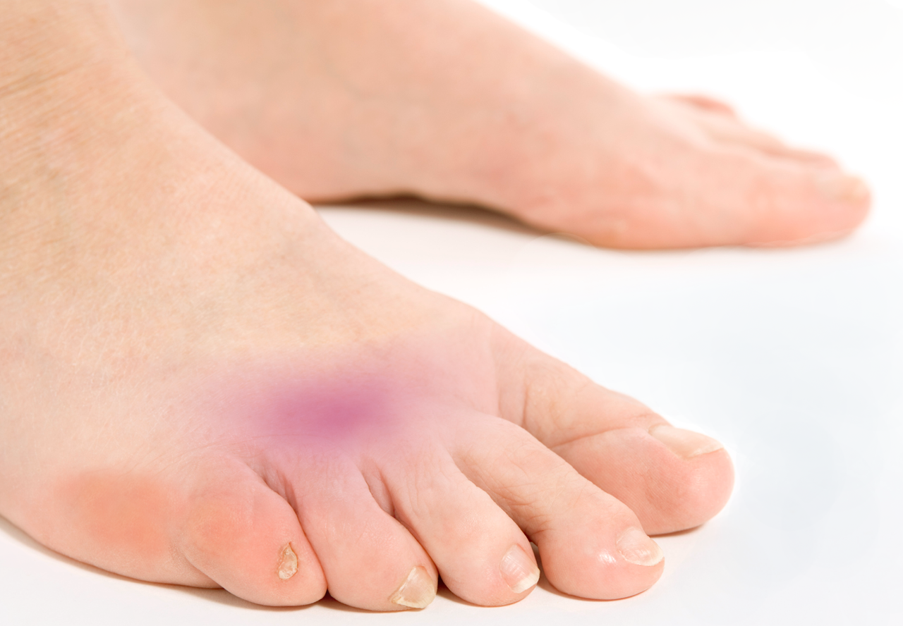 Neuroma - Relieve Foot Pain & Leg Pain