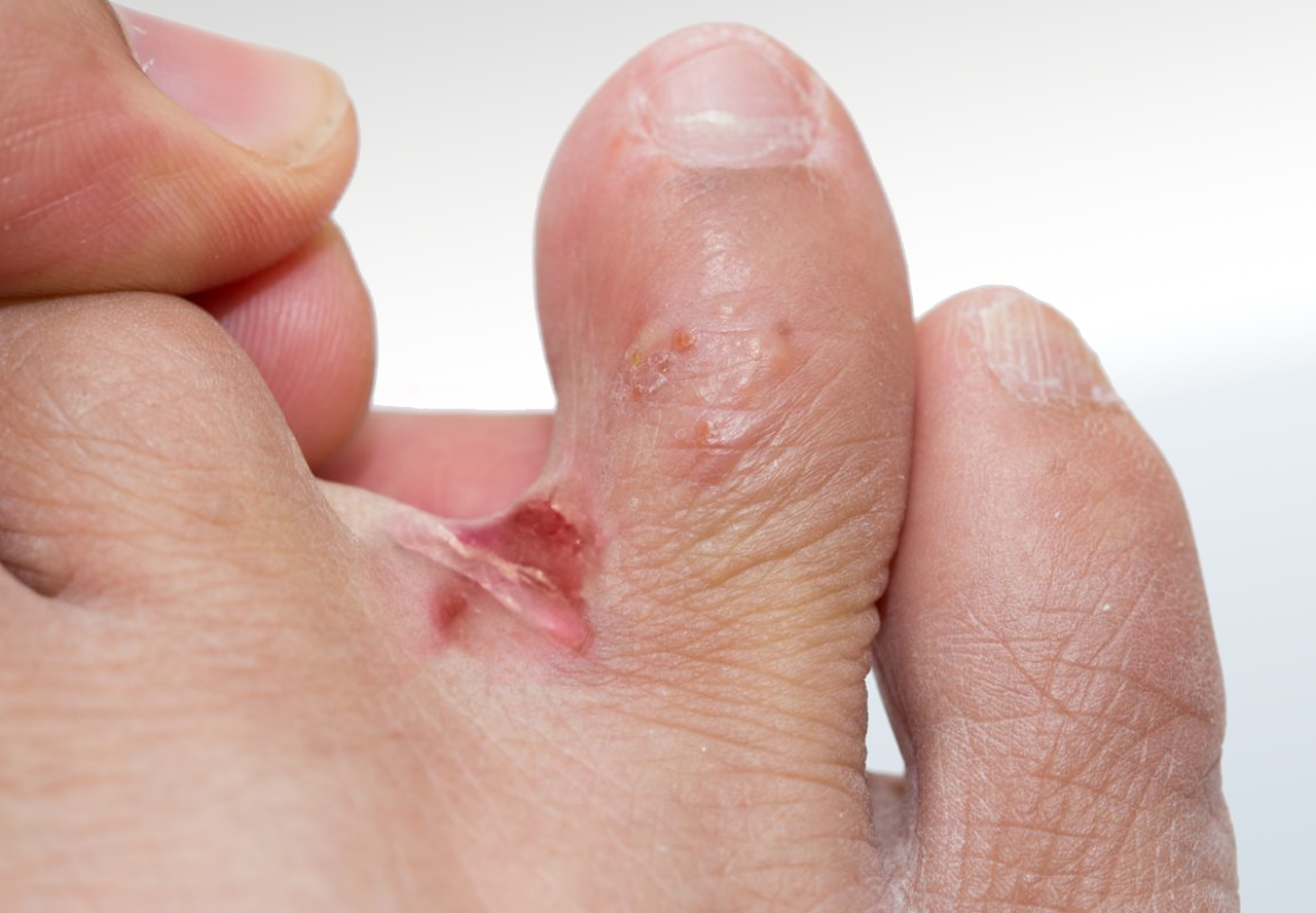 Wound - Relieve Foot Pain & Leg Pain