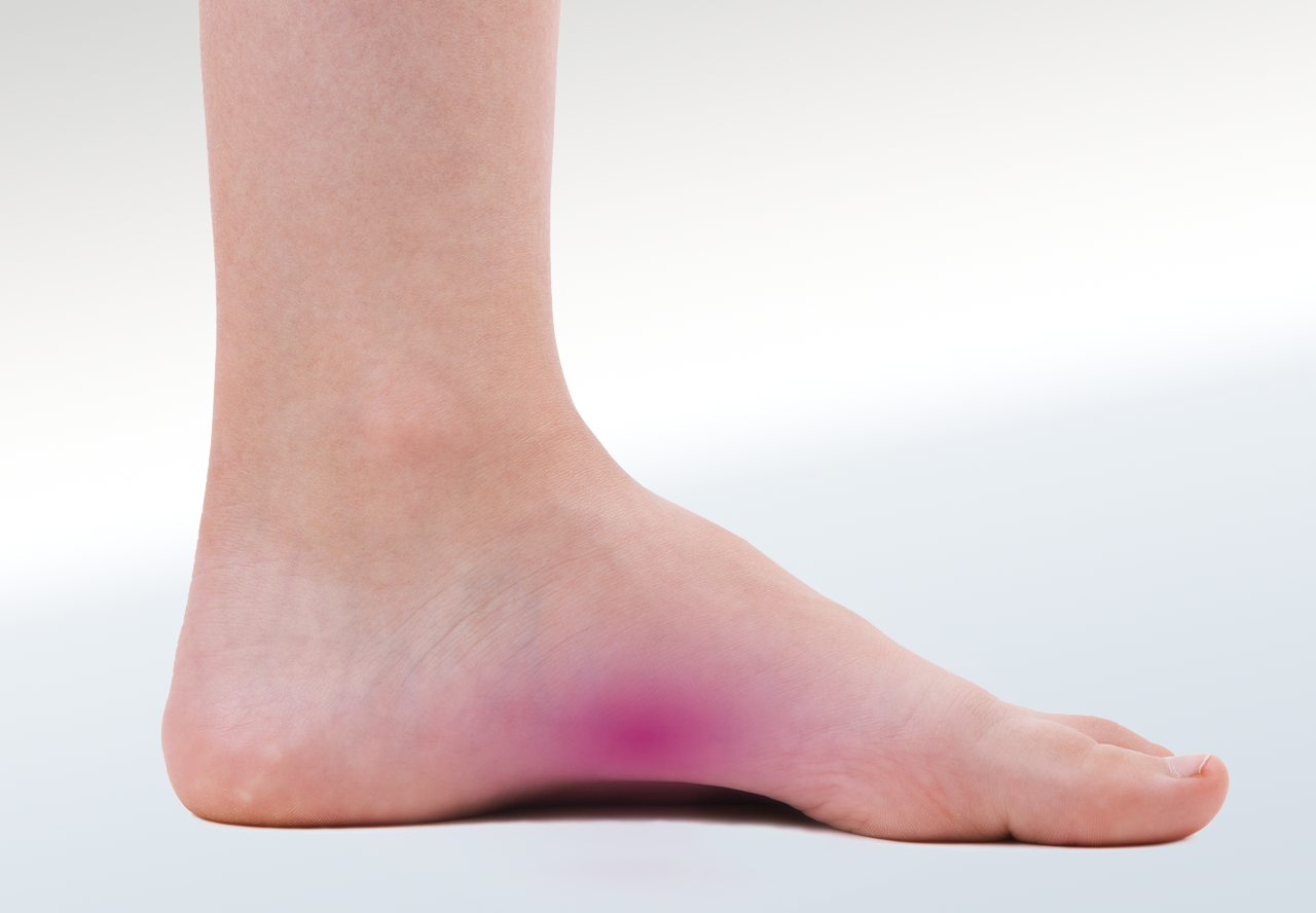 Arch Pain - Relieve Foot Pain & Leg Pain