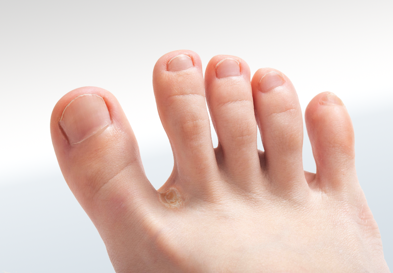 Corns - Relieve Foot Pain & Leg Pain