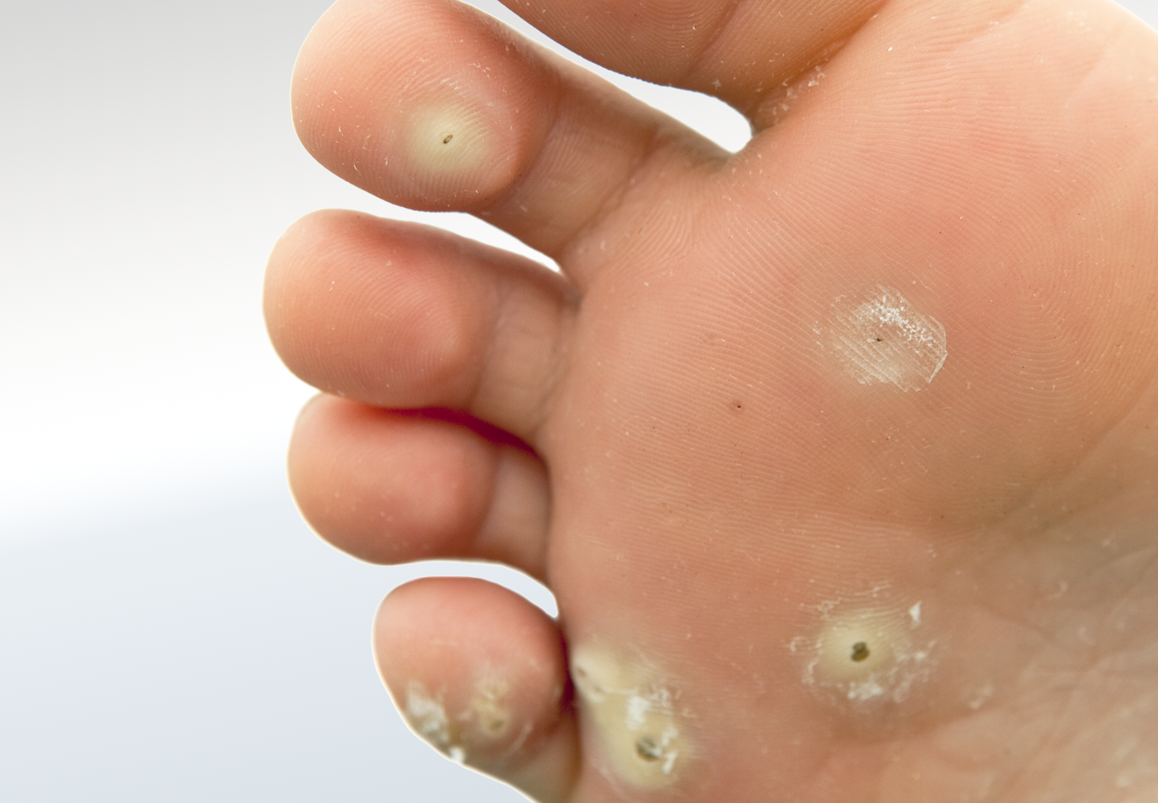 Wart - Relieve Foot Pain & Leg Pain