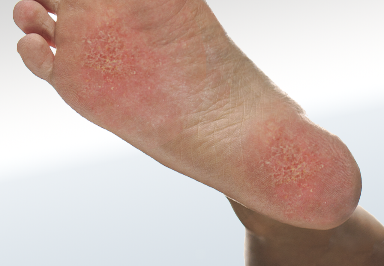 Eczema In Feet Photos At Caitlyn Lavater Blog