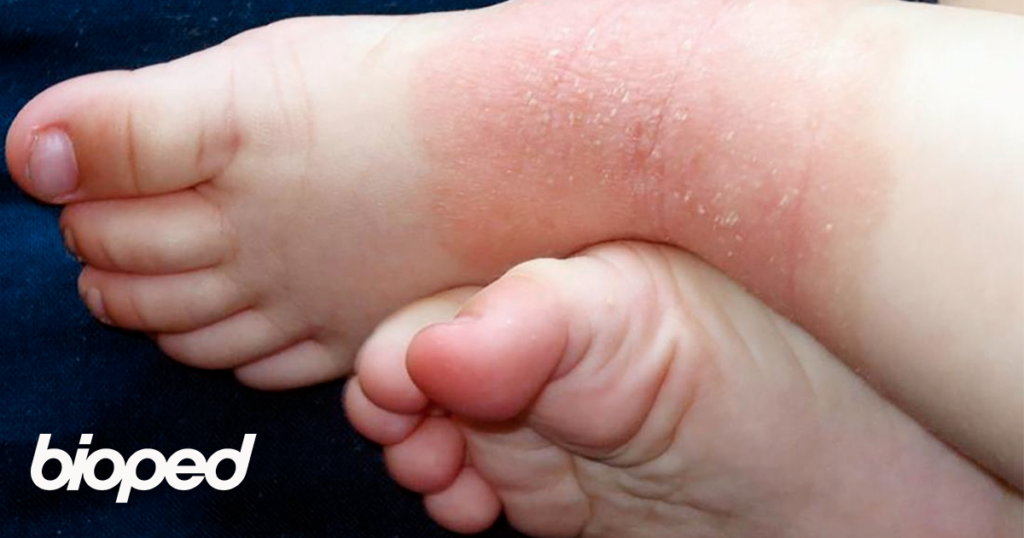 Psoriatic Arthritis In The Foot (What Can Be Done?) - BioPed Footcare