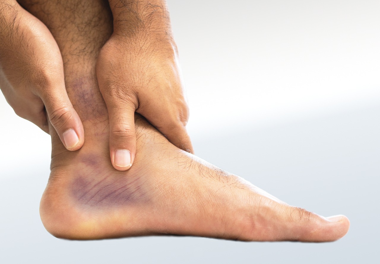 Sprain/Strain - Relieve Foot Pain & Leg Pain