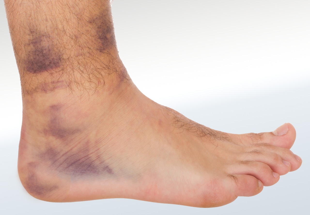 Sprain/Strain - Relieve Foot Pain & Leg Pain