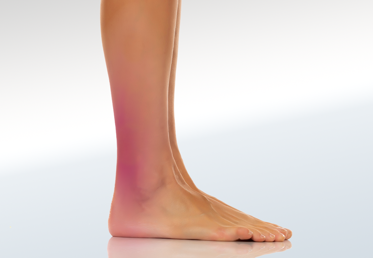 Peroneal Tendinitis - Relieve Foot Pain & Leg Pain
