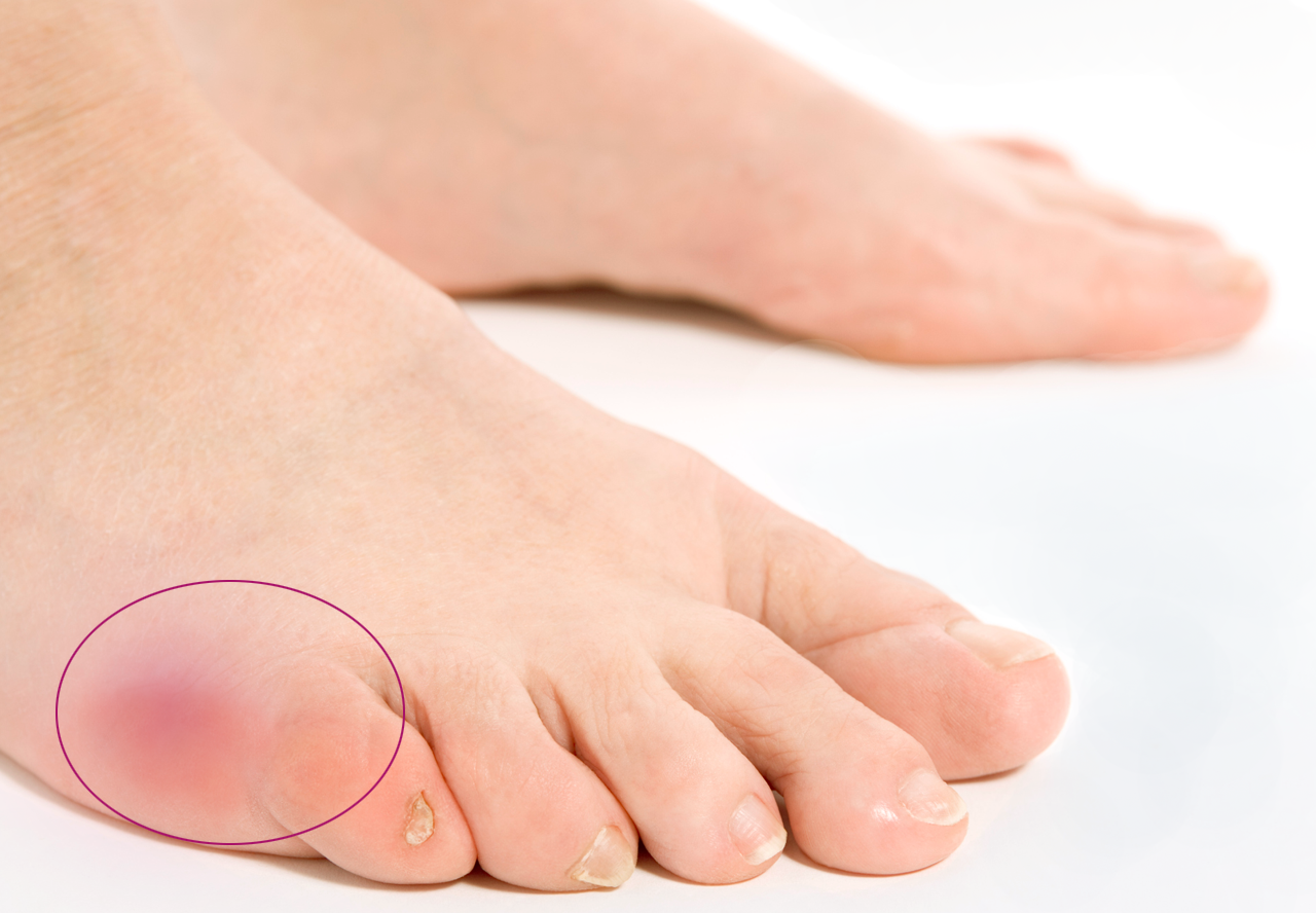 Shoe Friction/Pressure - Relieve Foot Pain & Leg Pain