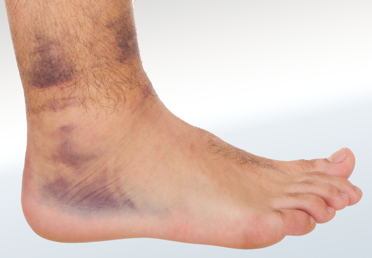 Sprain/Strain - Relieve Foot Pain & Leg Pain