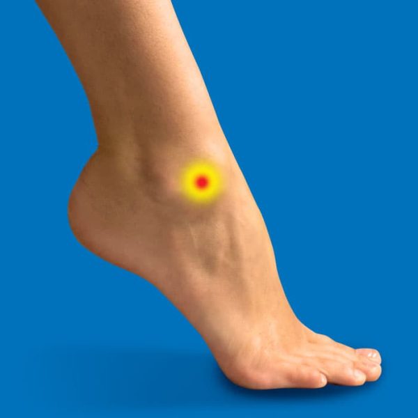 Capsular Impingement - Relieve Foot Pain & Leg Pain