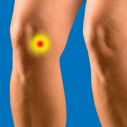 MCL Tear - Relieve Foot Pain & Leg Pain